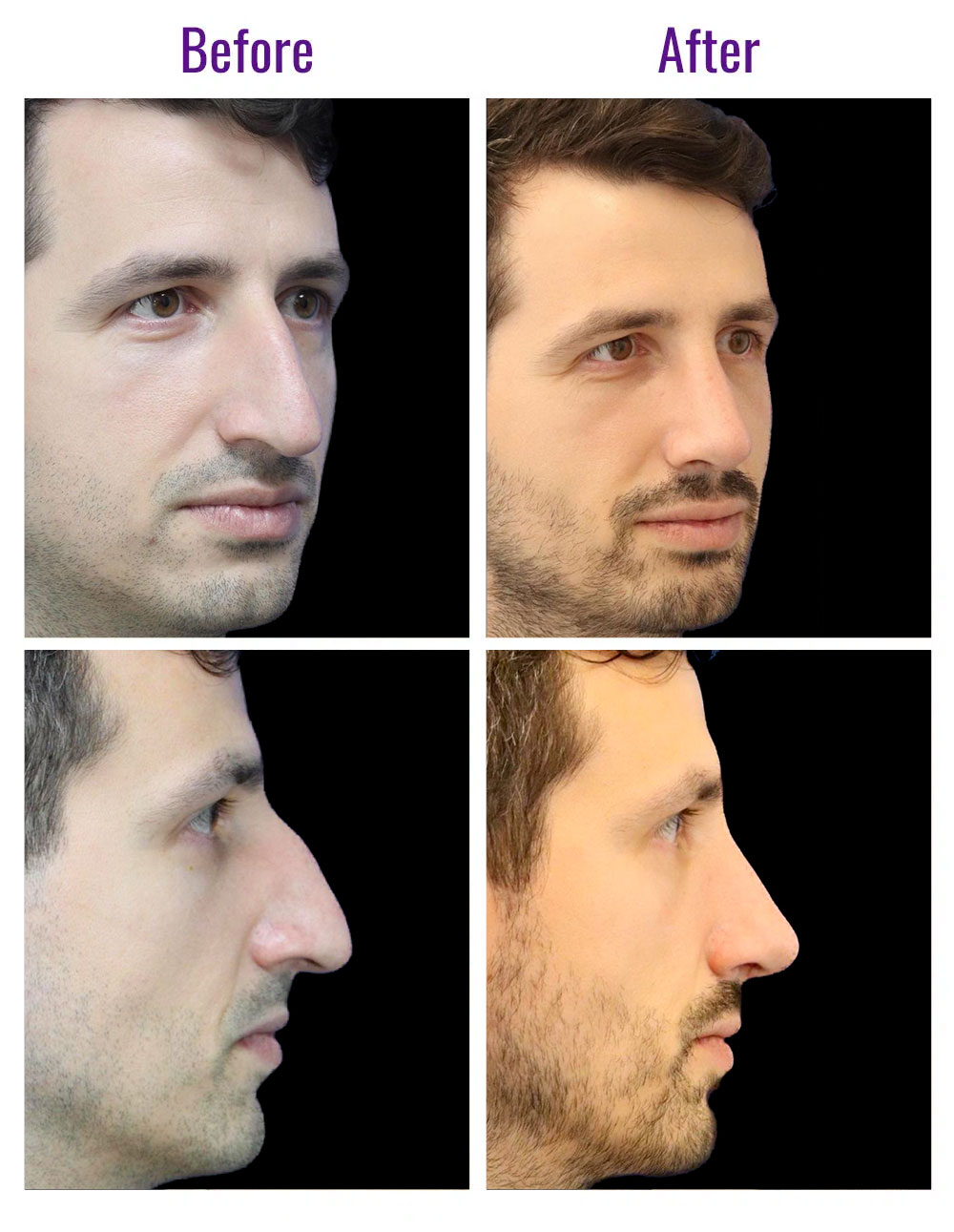 before after rinoplastie dr mahmoud daoud - cronosmed | Cronos Med